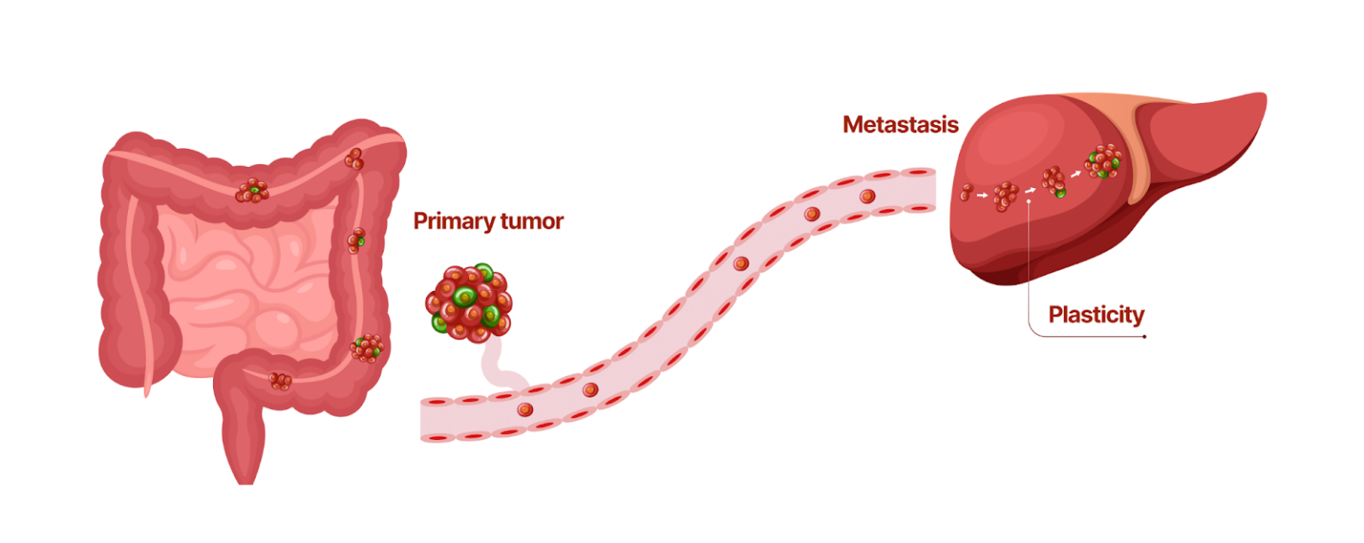 Progressive plasticity in colorectal cancer metastasis: a comprehensive ...